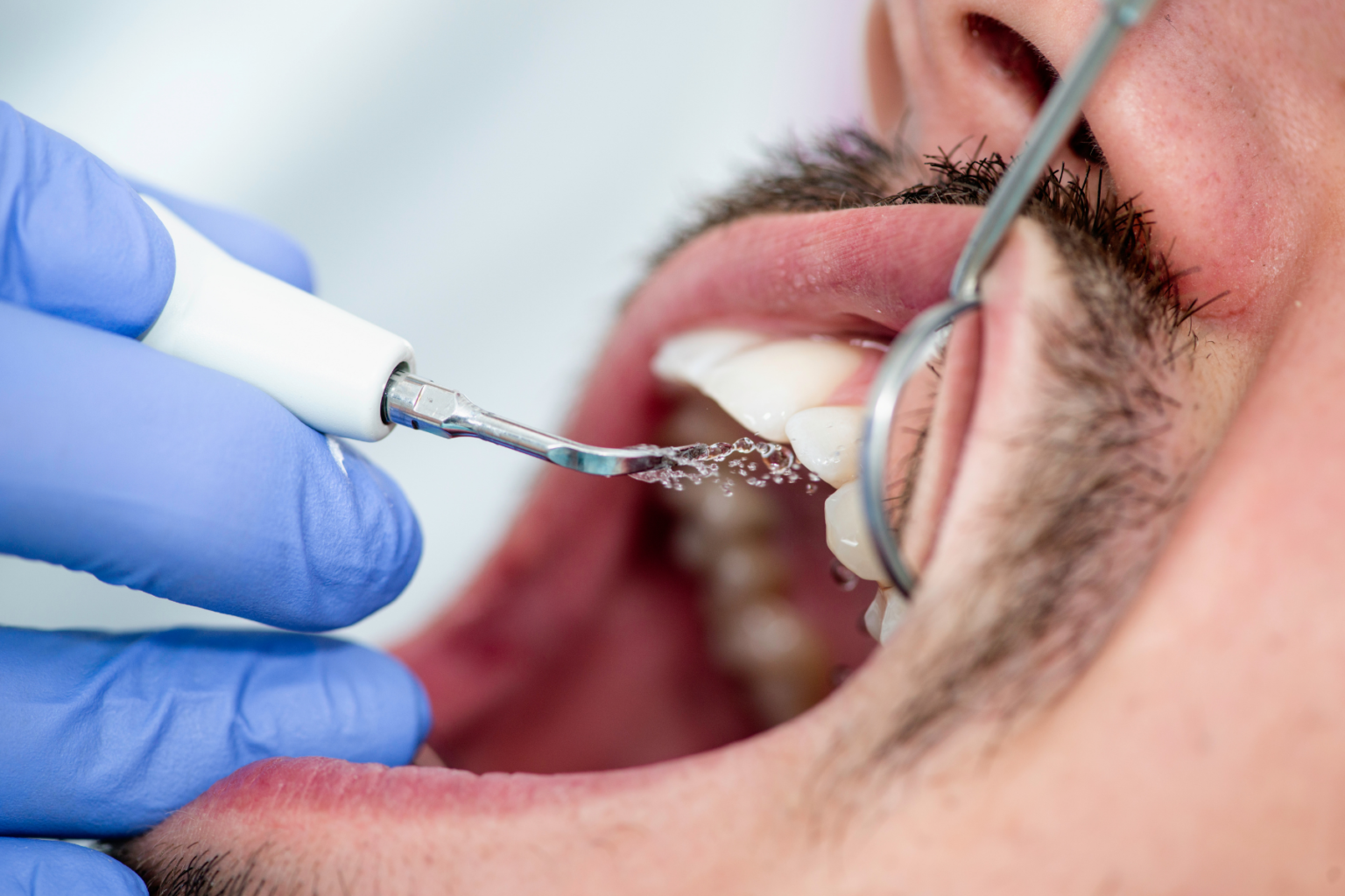 How To Remove Plaque And Tartar From Your Teeth • Christina All Day