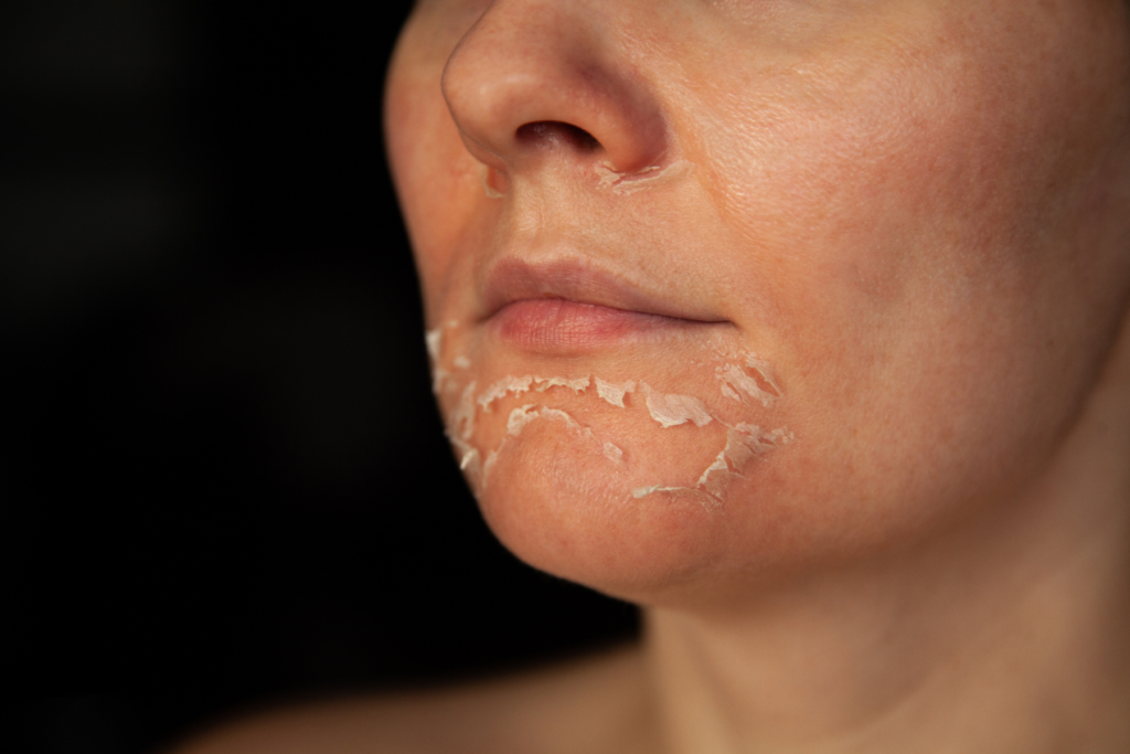 Dermaplaning Vs Chemical Peels Christina All Day Dermaplaning Vs Chemical Peels Christina All Day